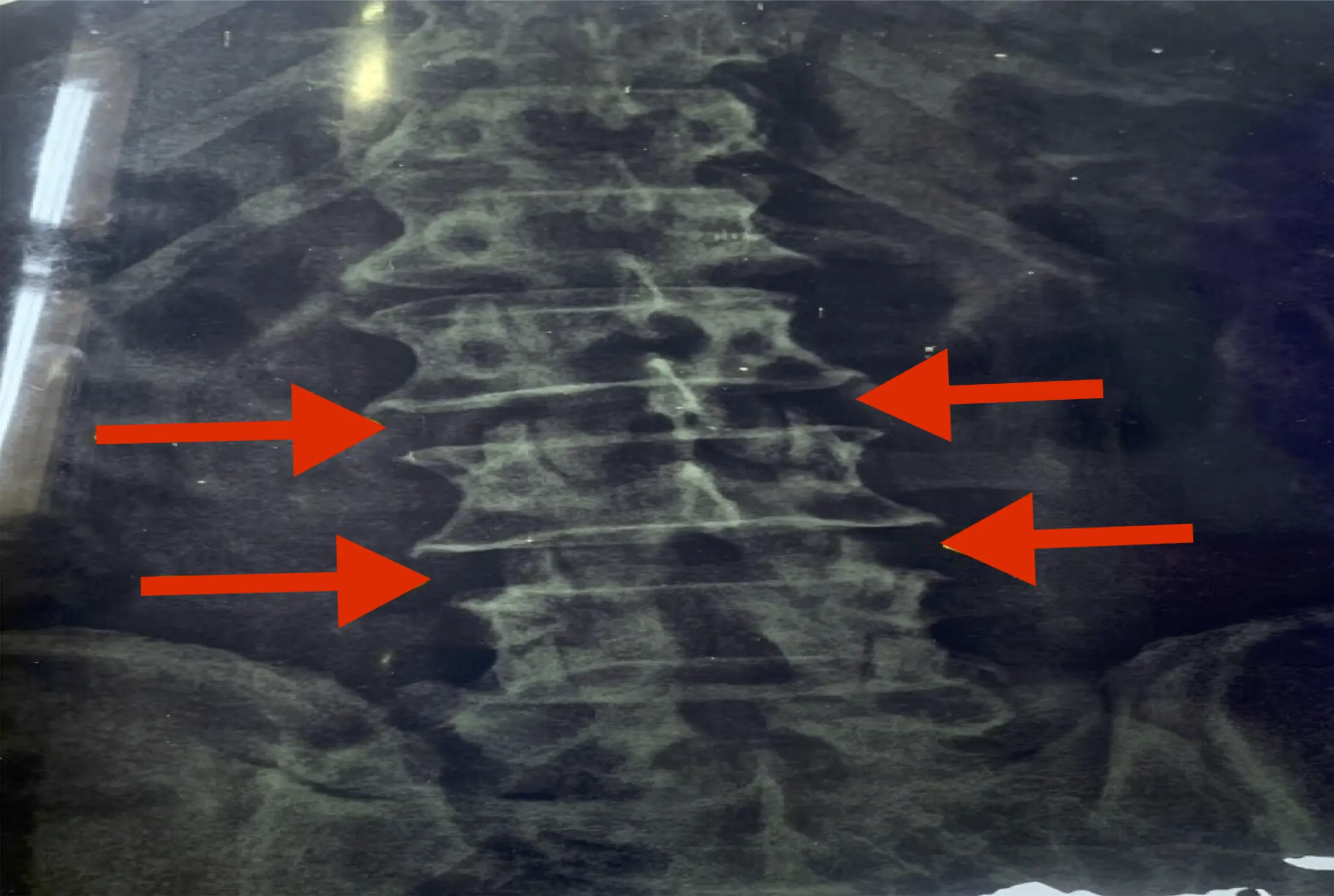 M47.816: Proven Treatments for Lumbar Spondylosis Relief!