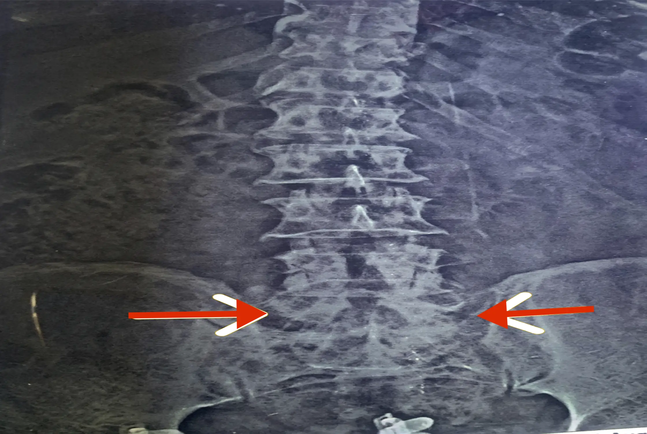 M47.816: Proven Treatments for Lumbar Spondylosis Relief!