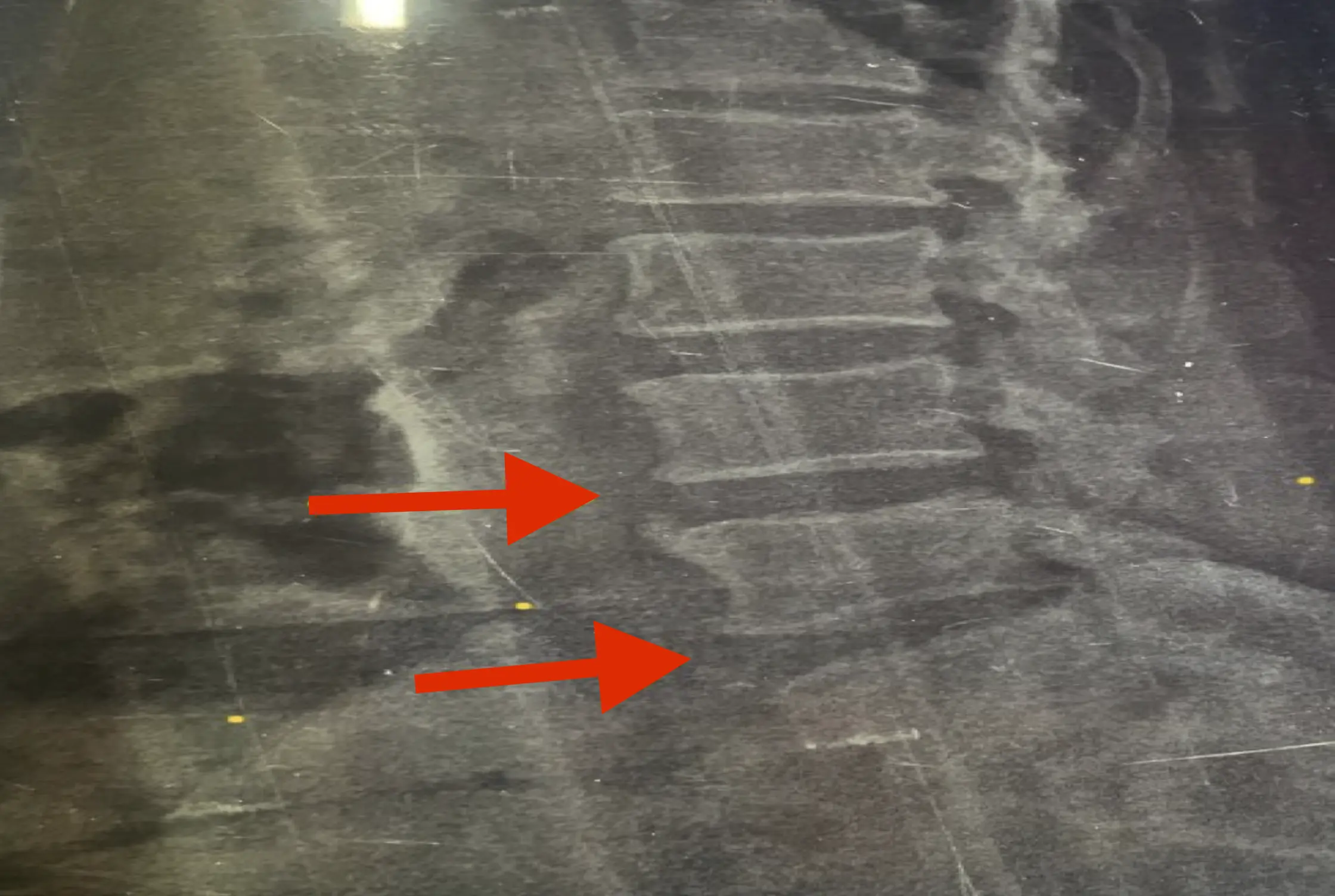 M47.816: Proven Treatments for Lumbar Spondylosis Relief!